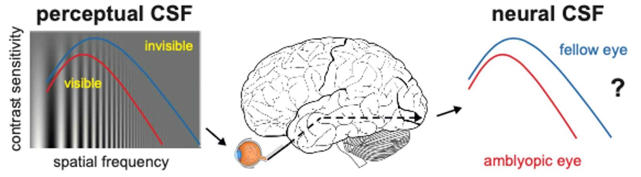 What happens in the brain in amblyopia?